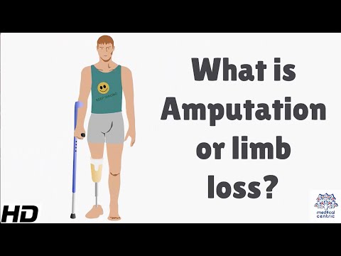 What is Amputation or Limb Loss?