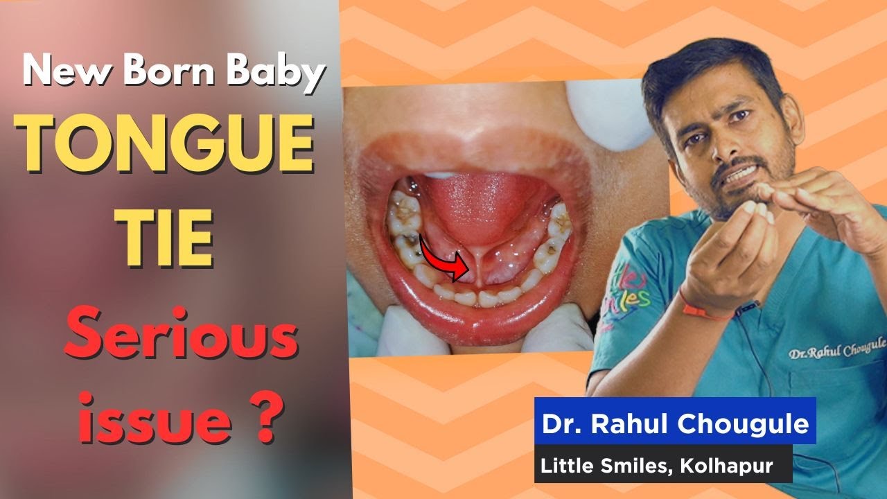 Is TONGUE TIE serious in New Born Baby ? - Dr. Rahul Chougule - YouTube