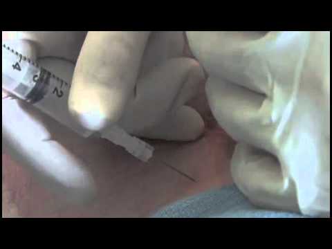 Lumbar Facet Ultrasound Guided Injection - How To - YouTube