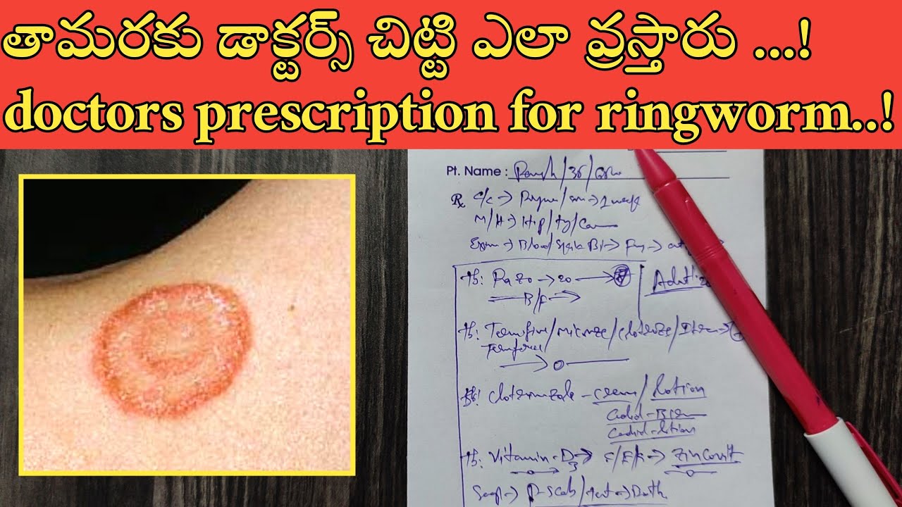 doctors prescription for ringworm😷 ll thamara in telugu ll skin problem ...