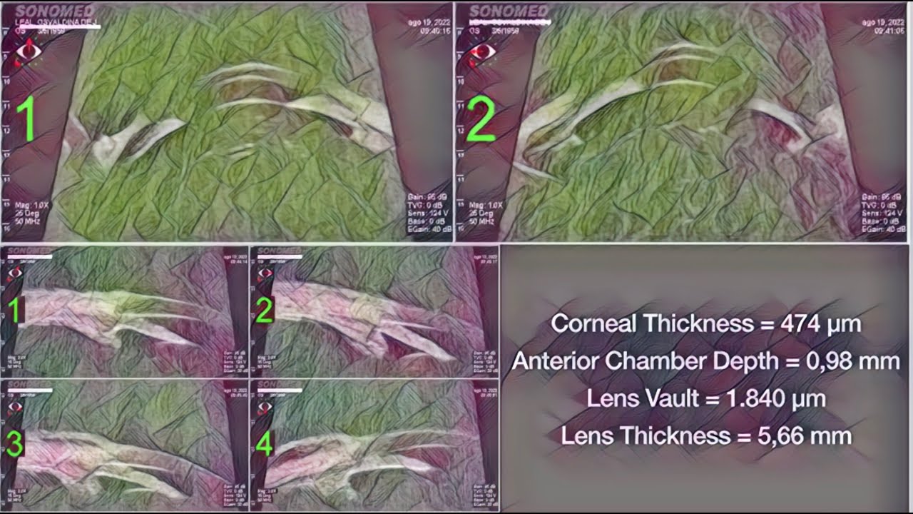 Capsulorhexis - Secondary Glaucoma (High Lens Rise) - YouTube