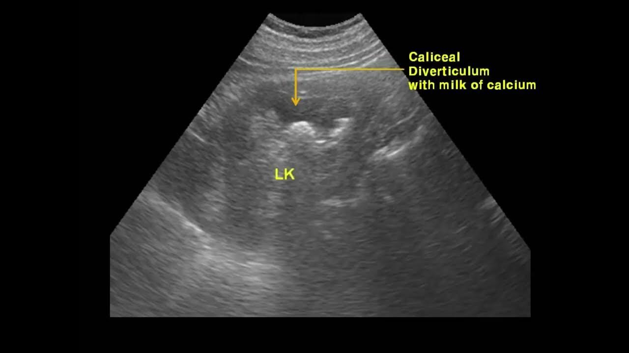 Caliceal Diverticulum With Milk Of Calcium 신배 게실 결석 Youtube