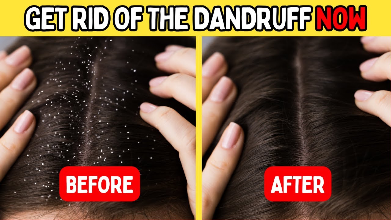 🔴[REVEALED]🔴: 6 Incredible Tips on How to Get Rid of Dandruff! # ...