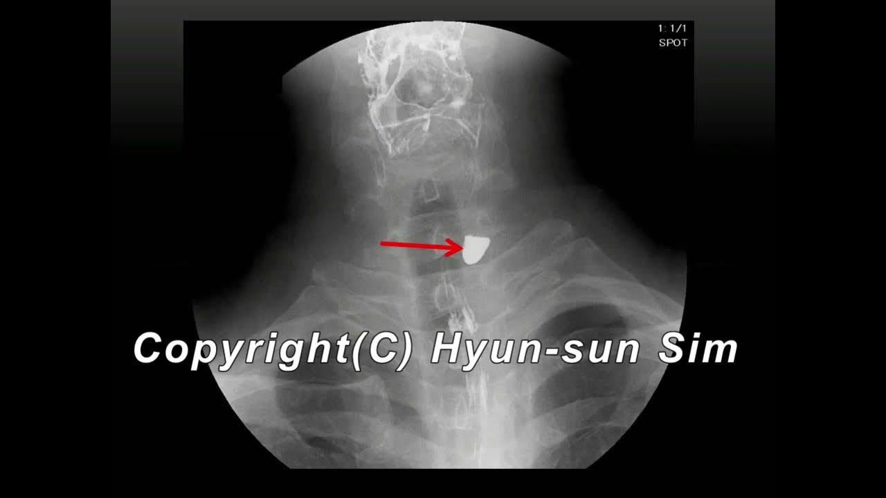 Upper Esophageal Diverticulum Ultrasonography 상부 식도 게실 Youtube