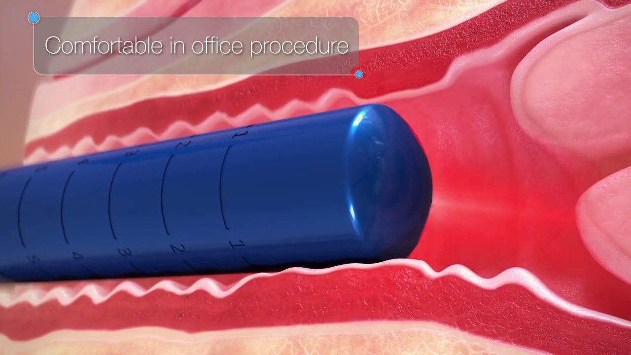 FemTouch On AcuPulse 360 For Women’s Health - YouTube