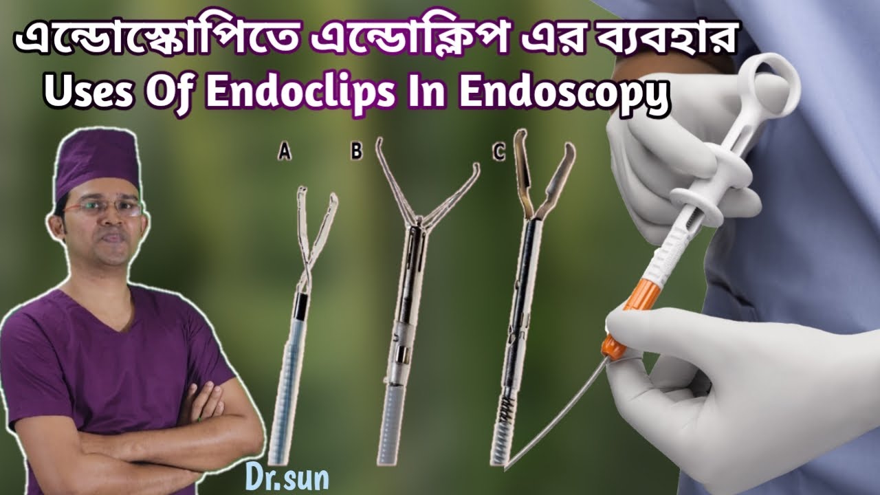 এন্ডোস্কোপিতে এন্ডোক্লিপ এর ব্যবহার || Uses Of Endoclips In Endoscopy ...