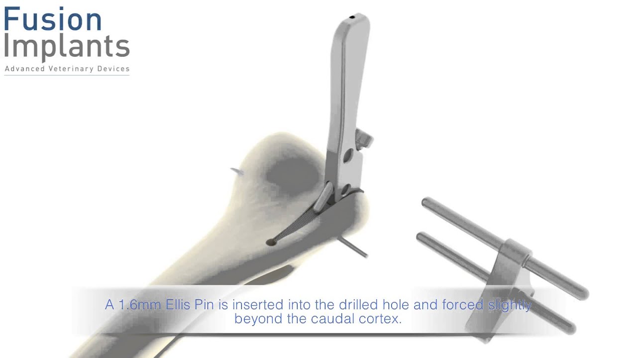 Fusion Implants - Fusion TTA Virtual Surgery - YouTube