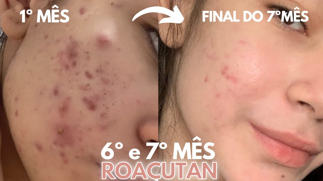 6º e 7º MÊS ROACUTAN | Diário Roacutan - YouTube