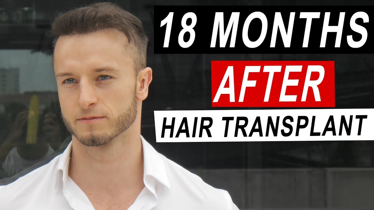 18 Months After My Fue Hair Transplant In Istanbul Turkey Youtube