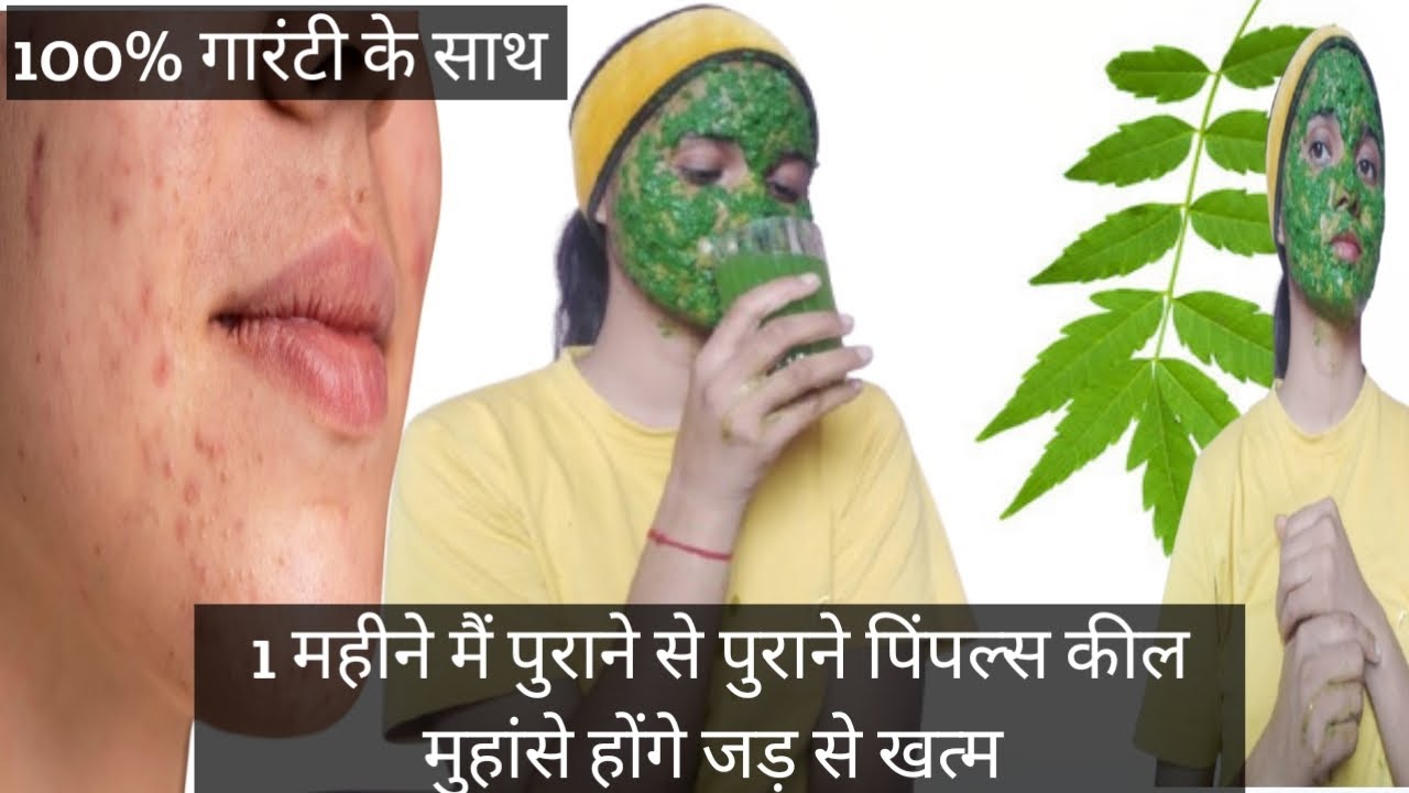 पुराने से पुराने पिंपल्स कील मुहांसे होंगे जड़ से दूर। face par Kil ...