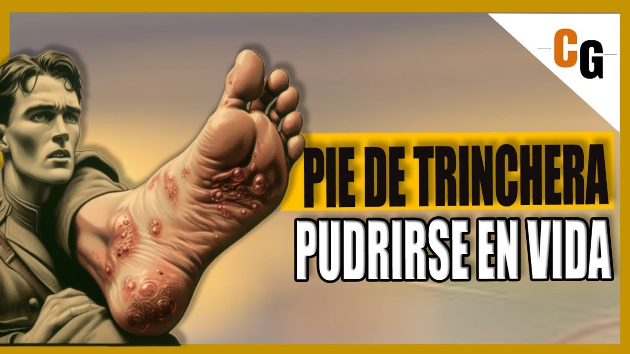 Pie de Trinchera - La Gangrena del Soldado - Explicacion Médica del Pie ...