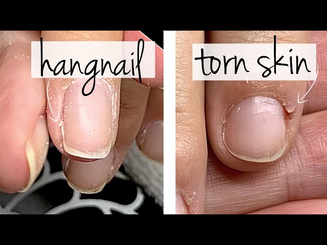 Hangnail