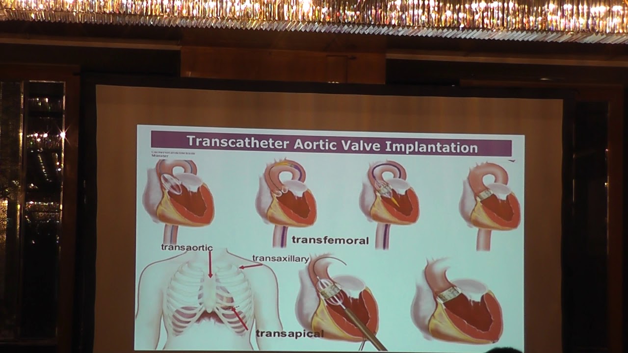 Update TAVI - YouTube