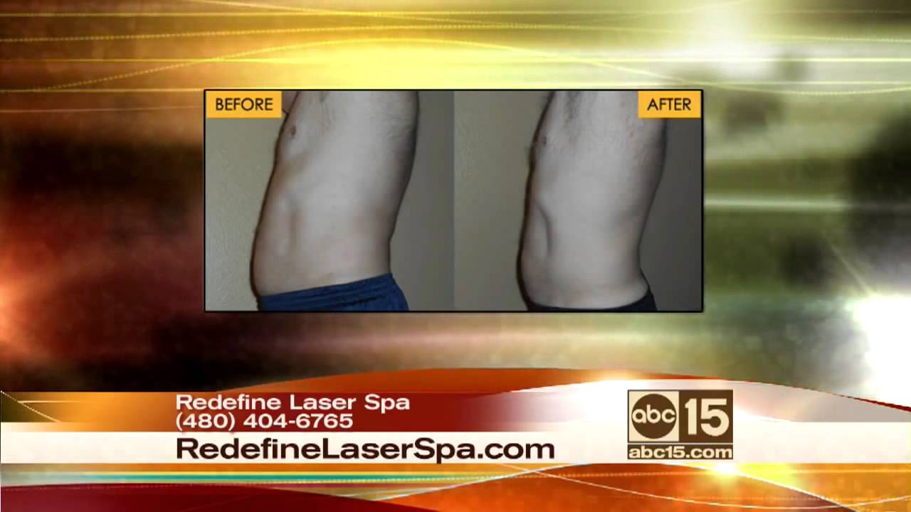 Strawberry Laser Lipo (ABC15 Arizona) - YouTube