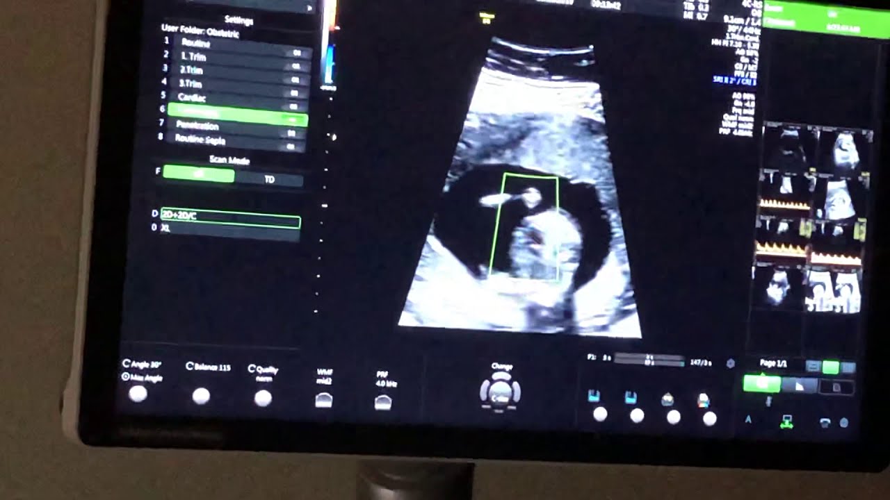 USG 13 semanas - YouTube