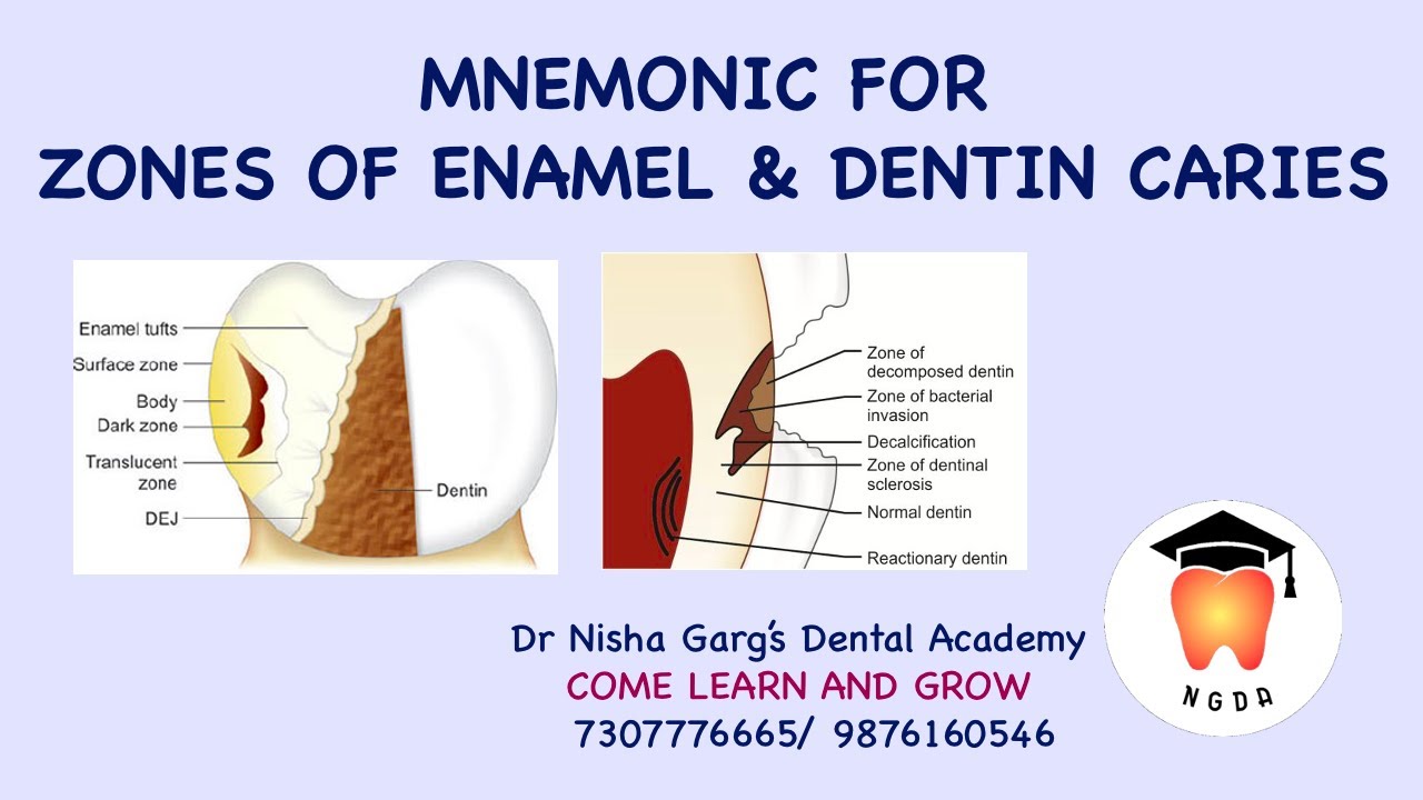 MNEMONIC FOR ZONES OF ENAMEL AND DENTIN CARIES DR NISHA GARG S DENTAL mnemonic-for-zones-of-enamel-and-dentin-caries-dr-nisha-garg-s-dental