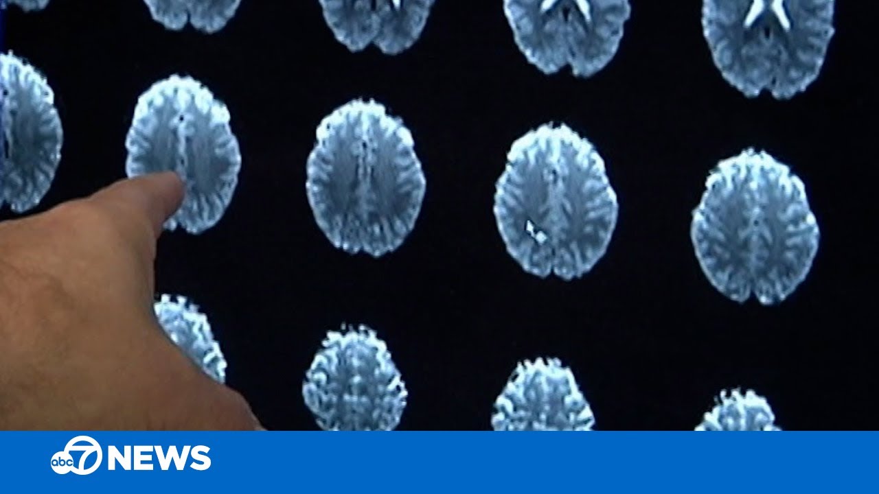 Study suggests human brain cells transplanted into a rat's can ...