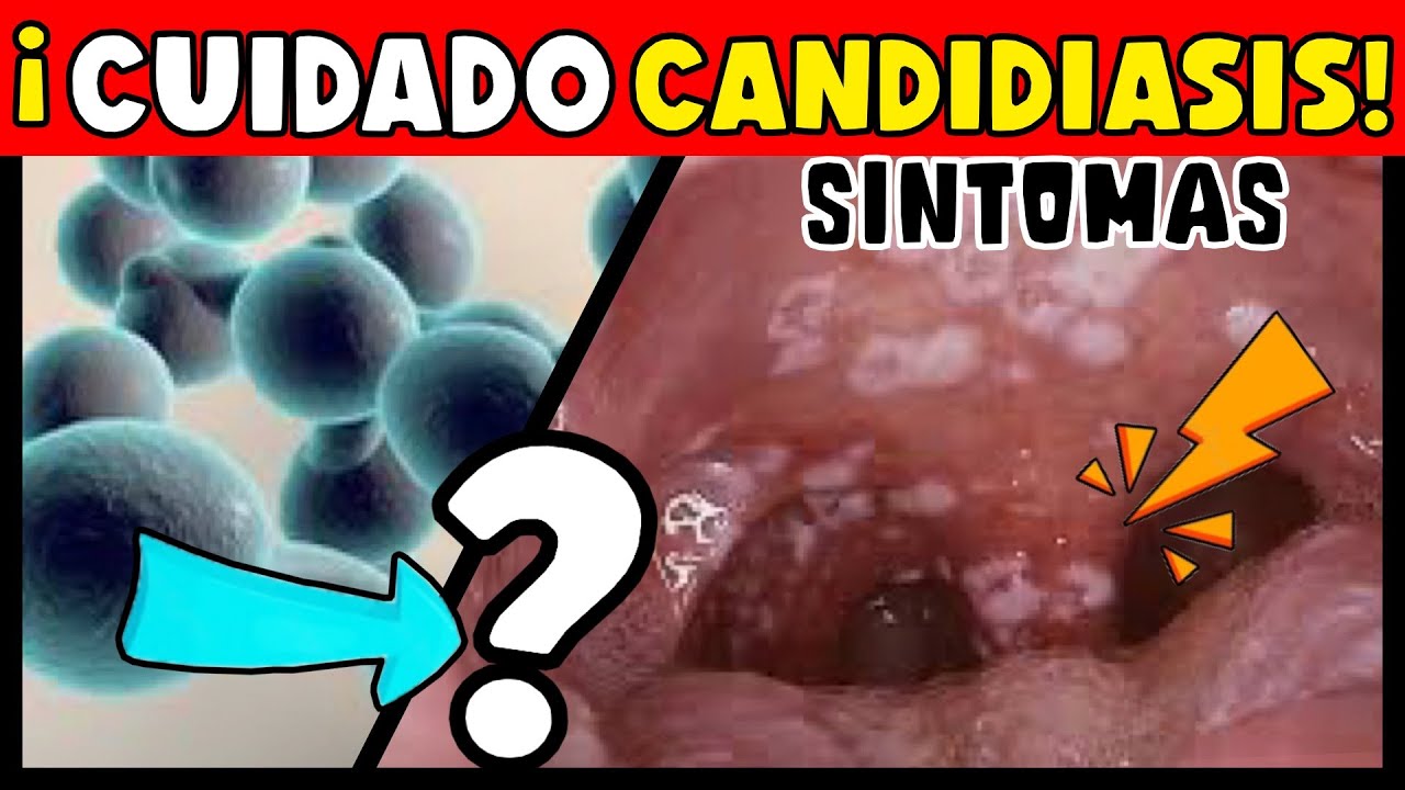 CUIDADO ⚠️¿QUÉ ES LA CANDIDIASIS? DIAGNÓSTICO & TRATAMIENTO - YouTube