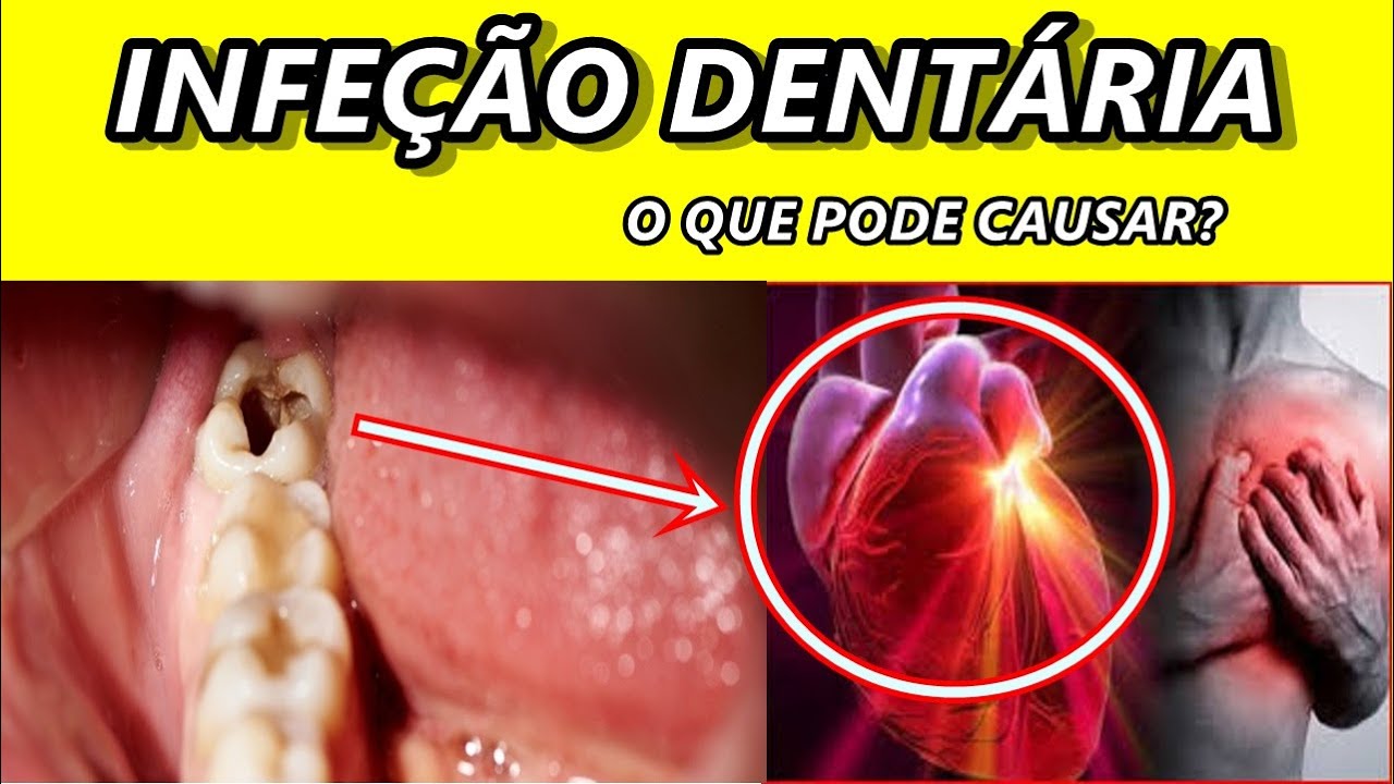 Infecção Dentária - sintomas e como tratar? É perigoso? - YouTube