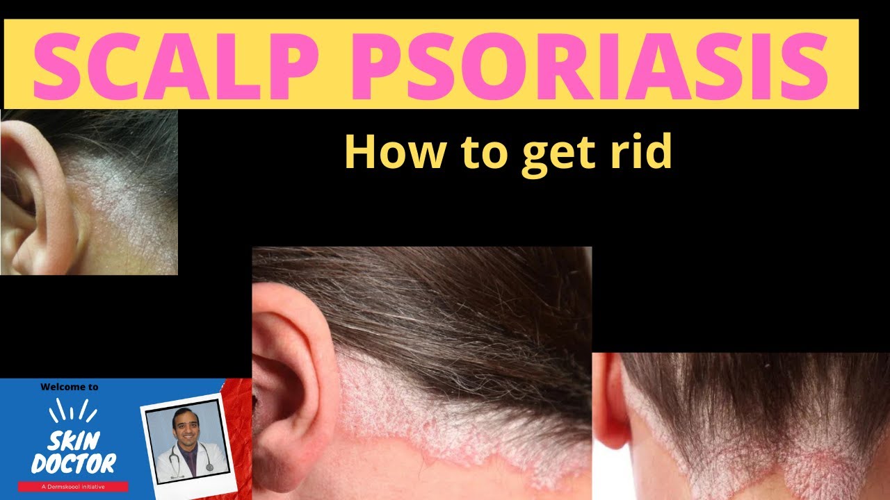 scalp psoriasis/ how to treat scalp psoriasis a Dermatologist speaks ...