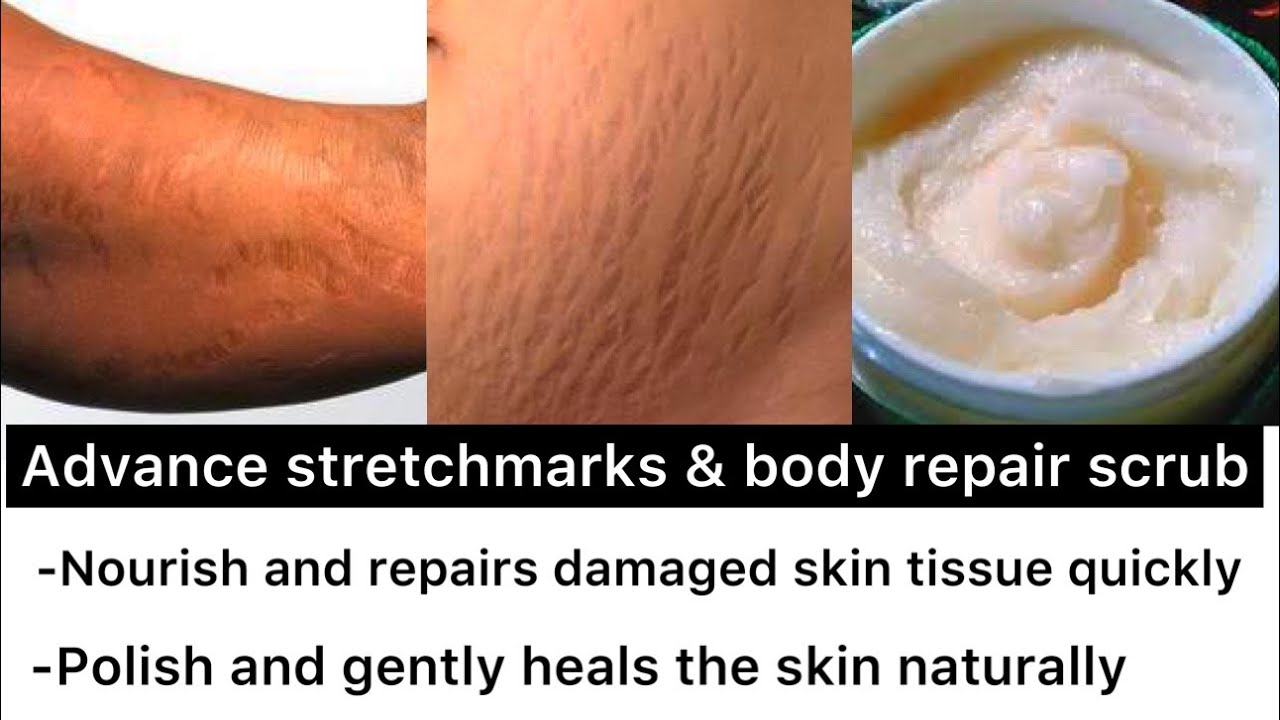 Advance Stretchmarks removal & body repair scrub - YouTube