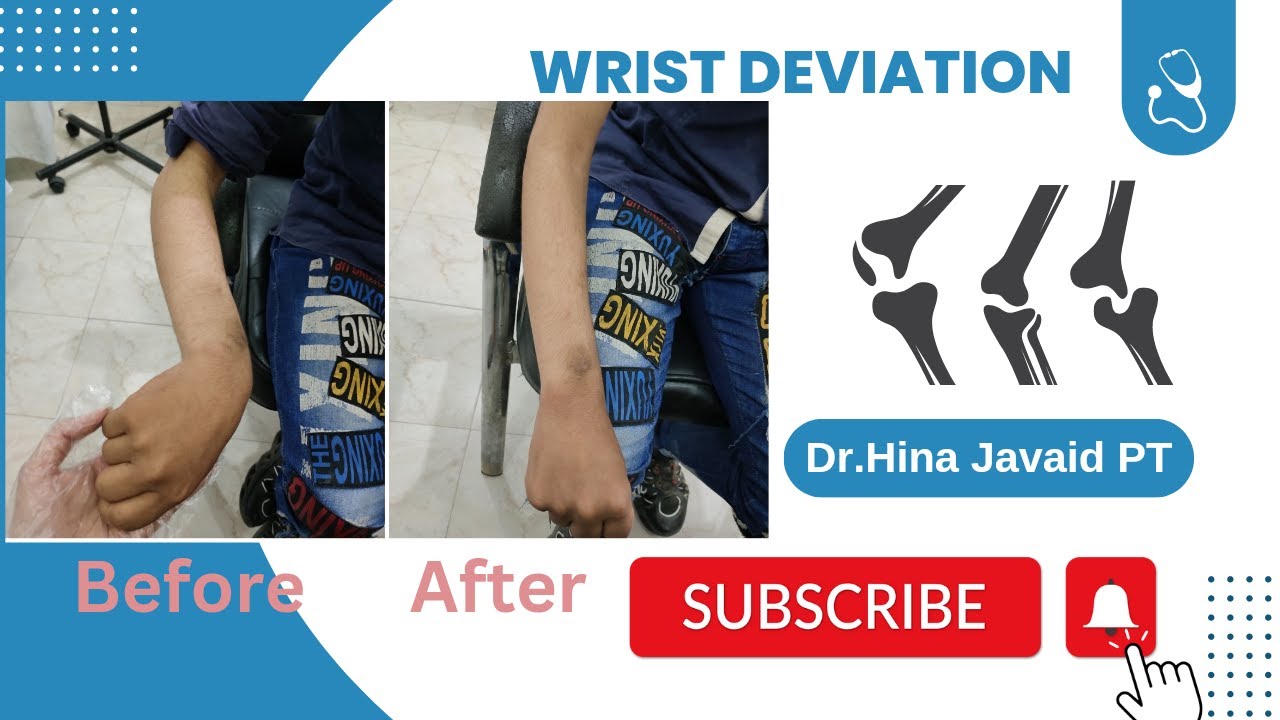 Wrist deviation treated with Physiotherapy. (Ulnar deviation deformity ...