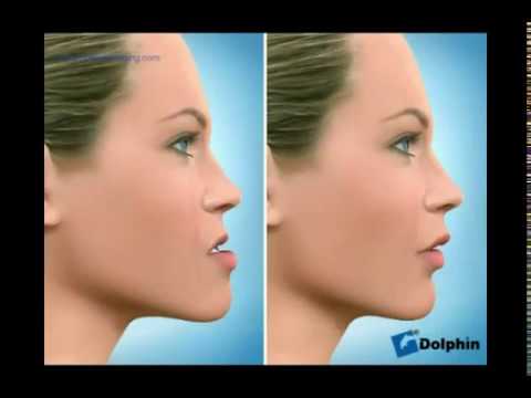 Orthognatic Surgery animation