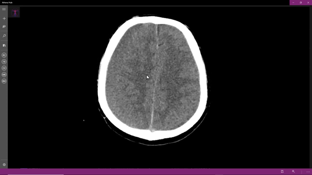 Hematoma subdural subagudo isodenso - YouTube