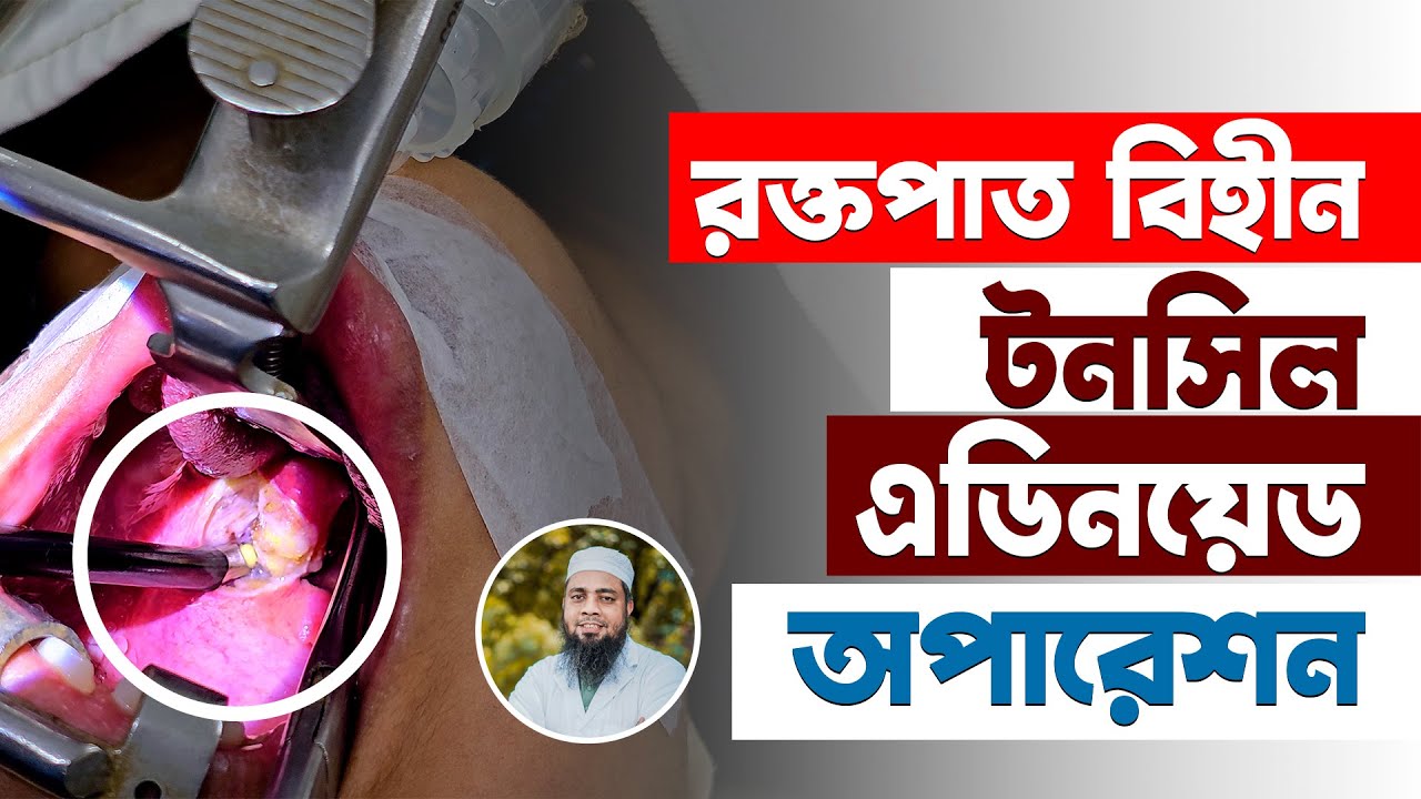 রক্তপাত বিহীন টনসিল এডিনয়েড অপারেশন | Tonsil Surgery | Adenoids ...