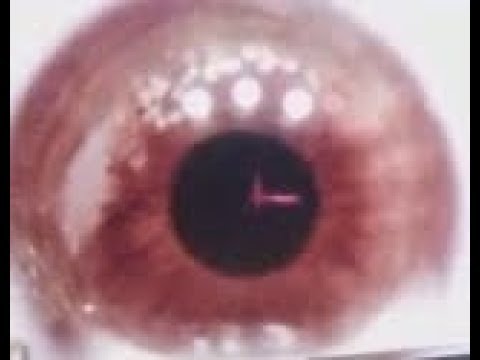 Intralase SBK Eye Surgery (Laser) - YouTube