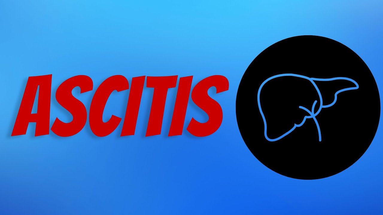 Ascitis - YouTube