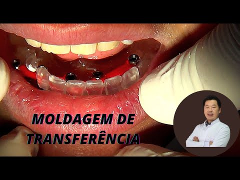 MOLDAGEM DE IMPLANTES PARA PRÓTESE PROTOCOLO INFERIOR, implantodontia ...