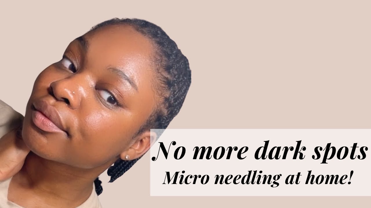 Micro needling AT HOME | Instantly remove hyperpigmentation and acne ...