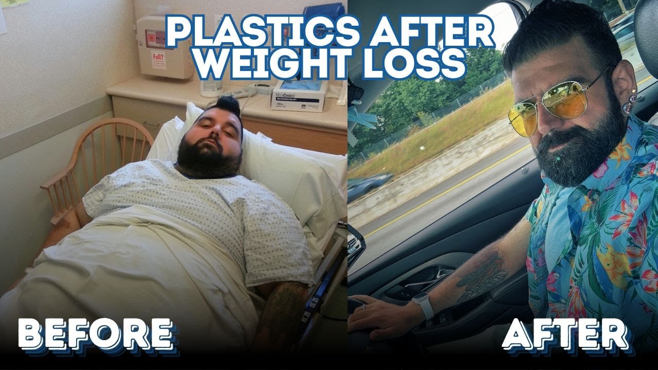 Dave's Life After Massive Weight Loss & Skin Removal w/ Dr. Katzen ...