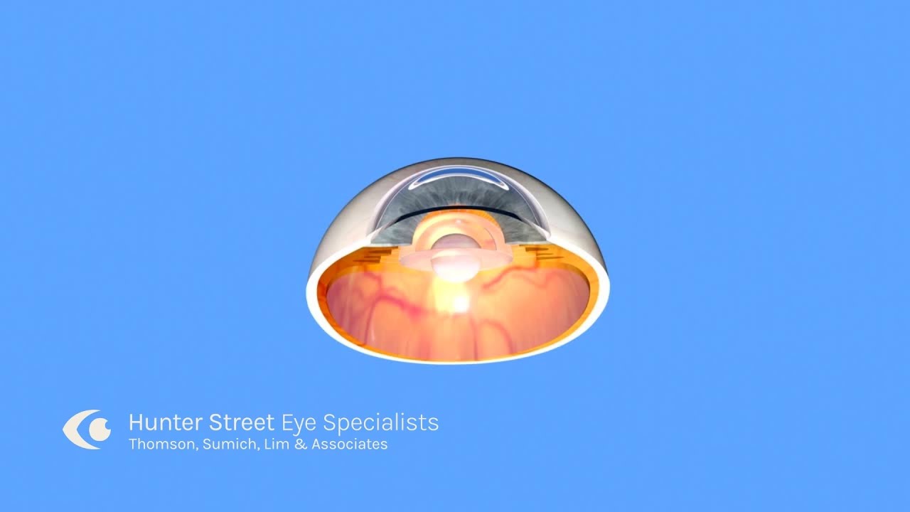 Vision Correction: Exploring Lens Extraction and Lens Implant Procedure ...