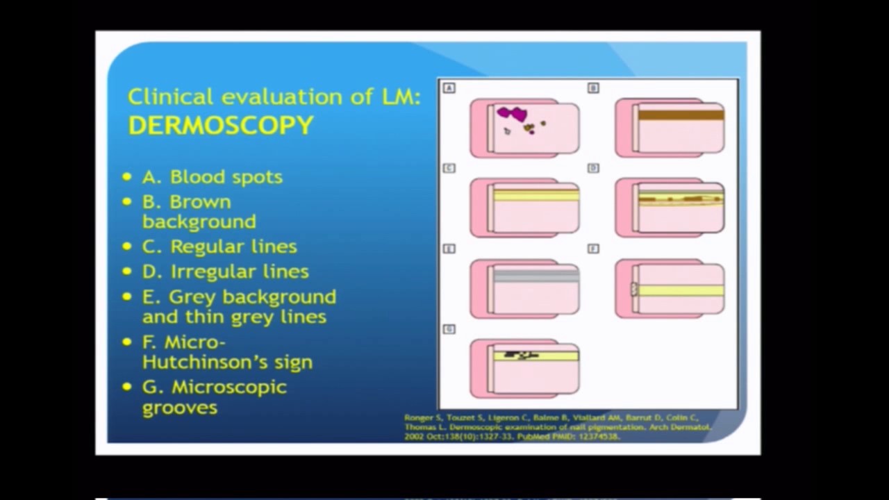Longitudinal Melanonychia - LECTURE SEGMENT ONLY - Chris Adigun, MD ...