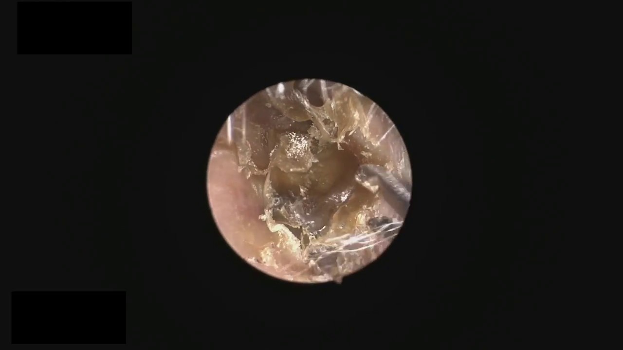 귀지제거, earwax, cerumen, 이비인후과 - YouTube