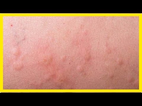 Comment traiter une éruption cutanée - YouTube