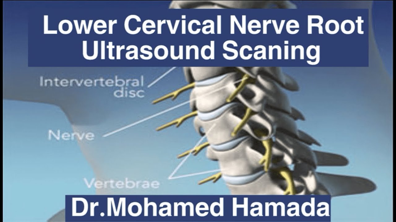 Lower Cervical Nerve Roots Ultrasound Scaning/Dr.Mohamed Hamada - YouTube
