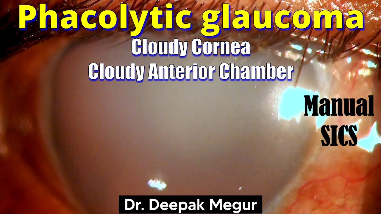 Phacolytic Glaucoma