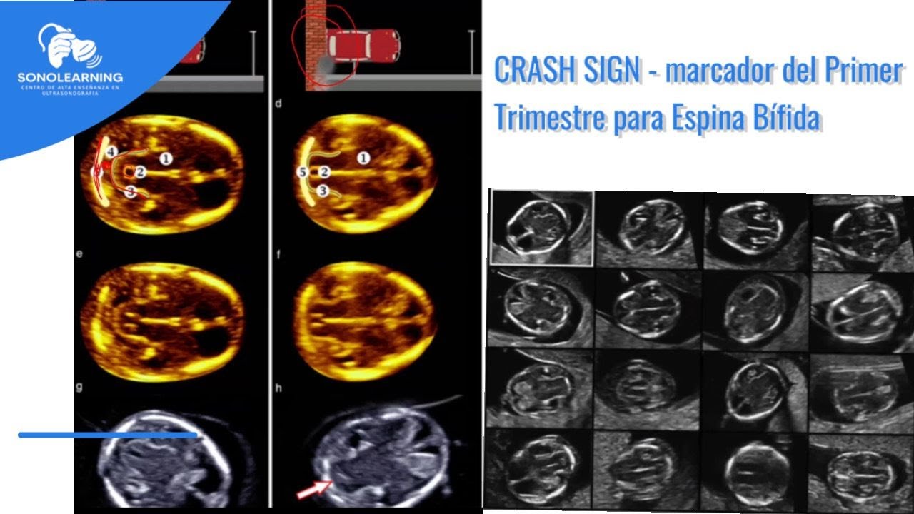 CRASH SIGN #embarazo #enseñanza #ultrasound #ecografia #docencia # ...