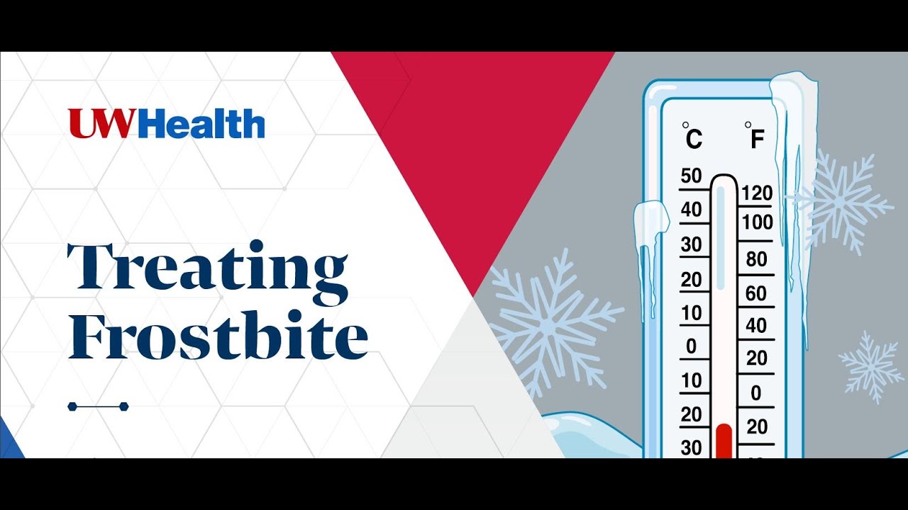 UW Health: Frostbite Education - YouTube