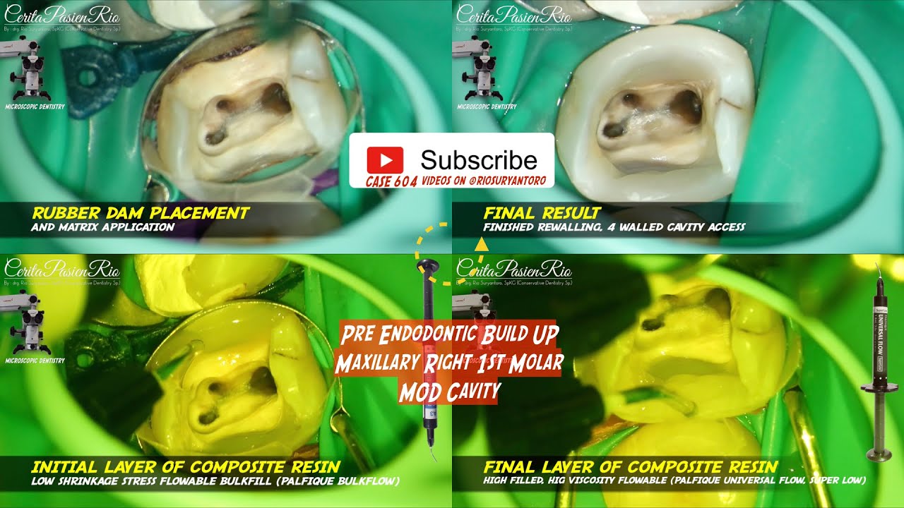 REWALLING PRE ENDODONTIC BUILD UP MOLAR - 4 WALLED ACCESS - PRECEDED ...