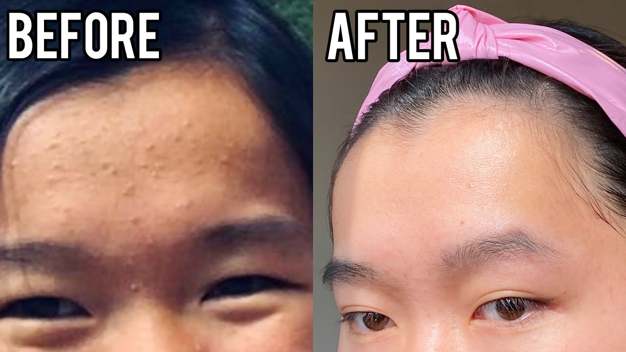 clear FOREHEAD acne/ texture FAST. use this SECRET acne product! clear ...