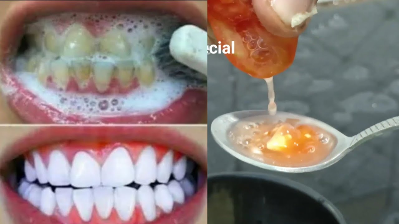 unbelievable! I swear to God, you will not go to the dentist to remove ...