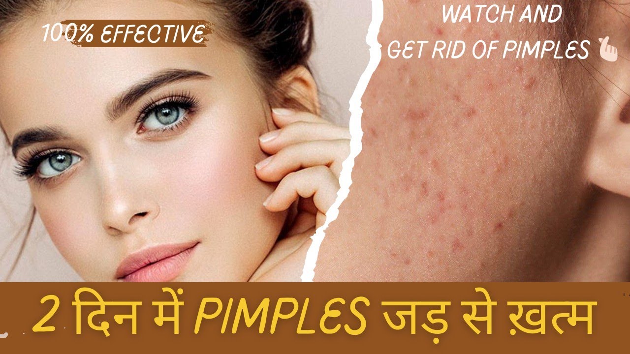 Pimples ka solution 🤗| 3 Simple Steps To Remove Pimples & Get Clear ...