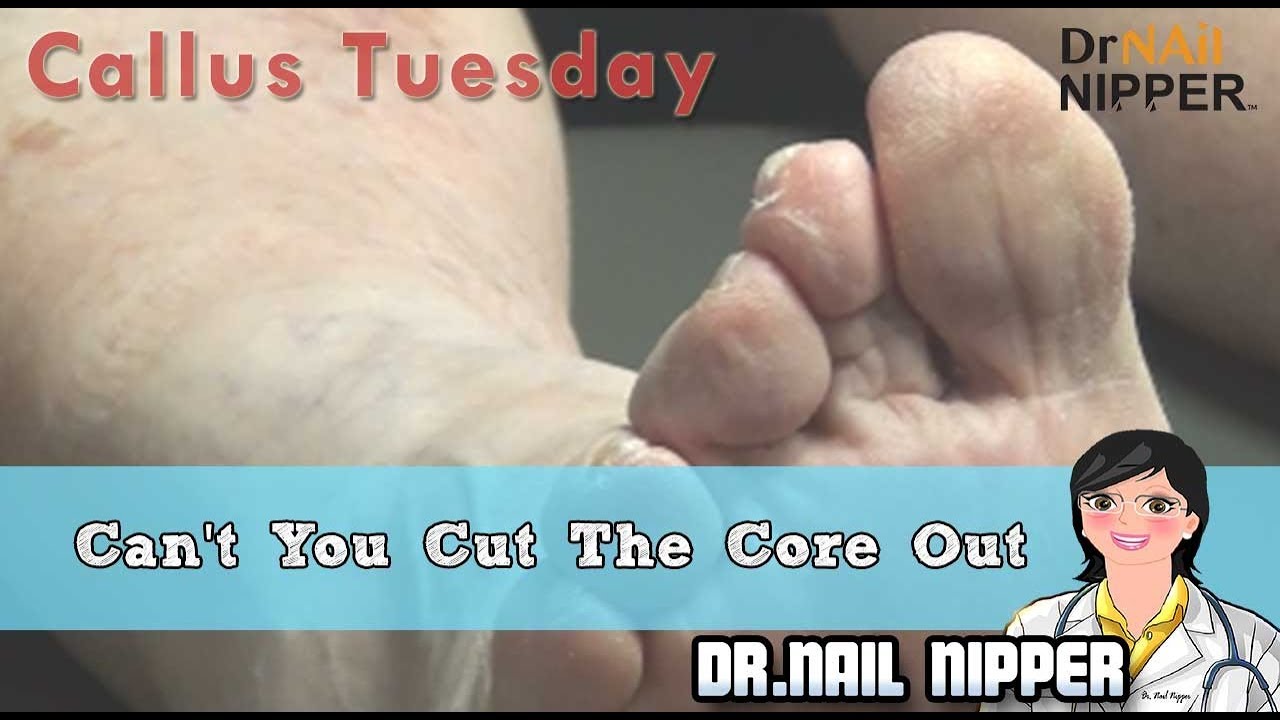 What does Foot Corn look like? Callus? Can't You Cut The Core Out ...