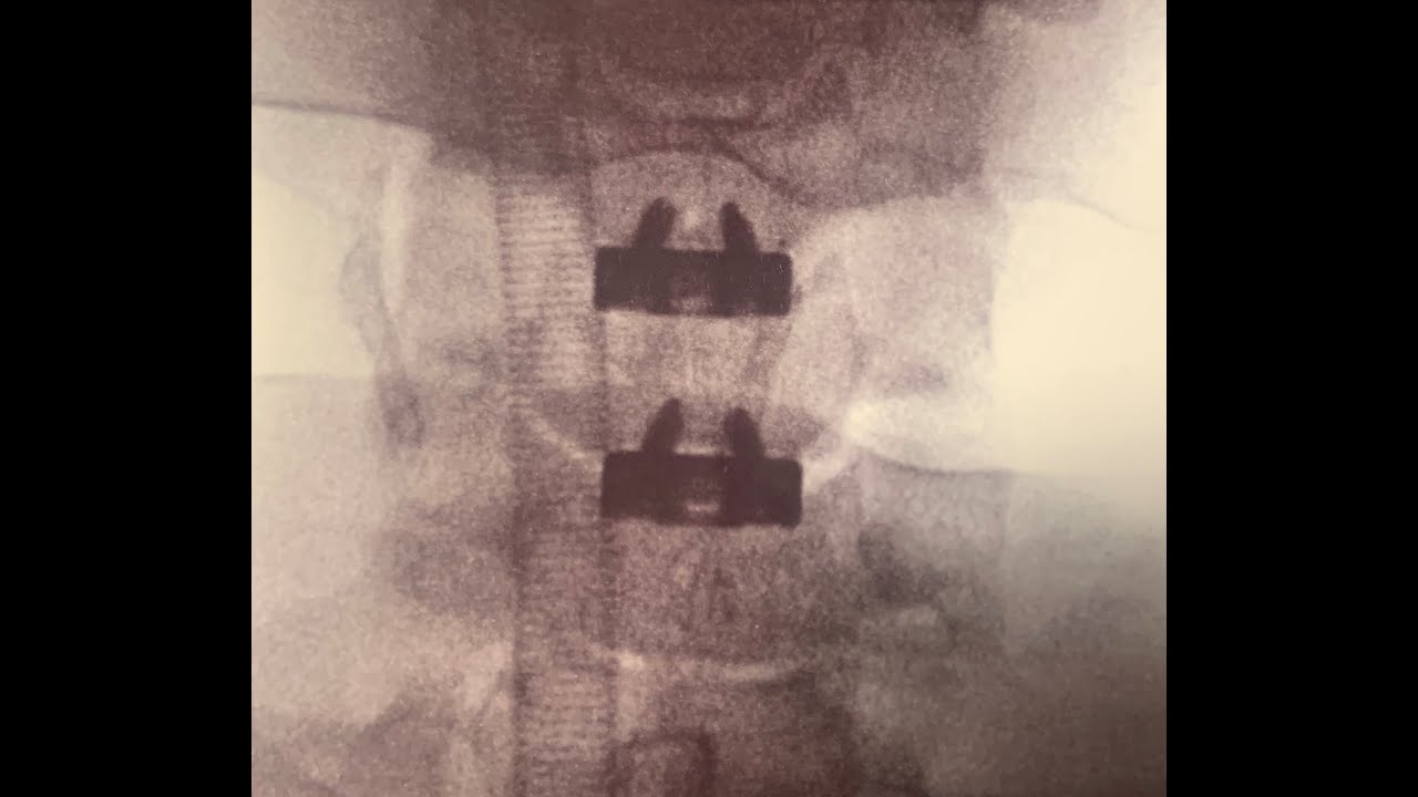 Día 18 post cirugía de columna cervical. Descompresión y artrodesis vía ...