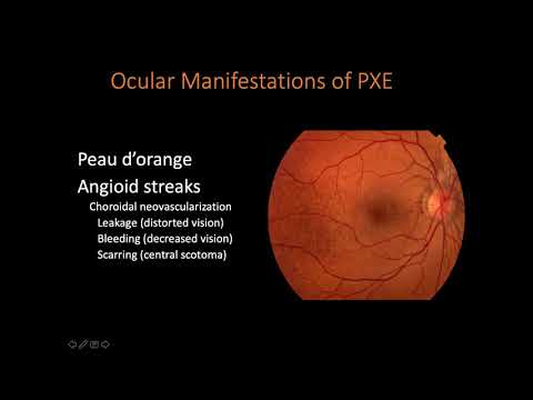 PXE International Virtual Conference 2020: PXE and the Eye
