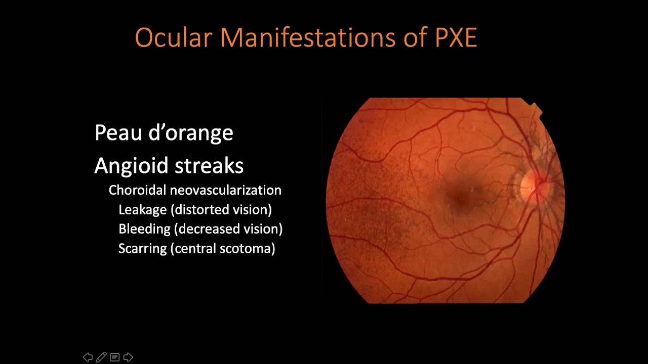 PXE International Virtual Conference 2020: PXE and the Eye - YouTube